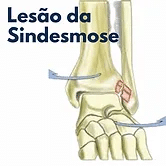 Lesões da Sindesmose | Ortopedista Especialista em Pé e Tornozelo