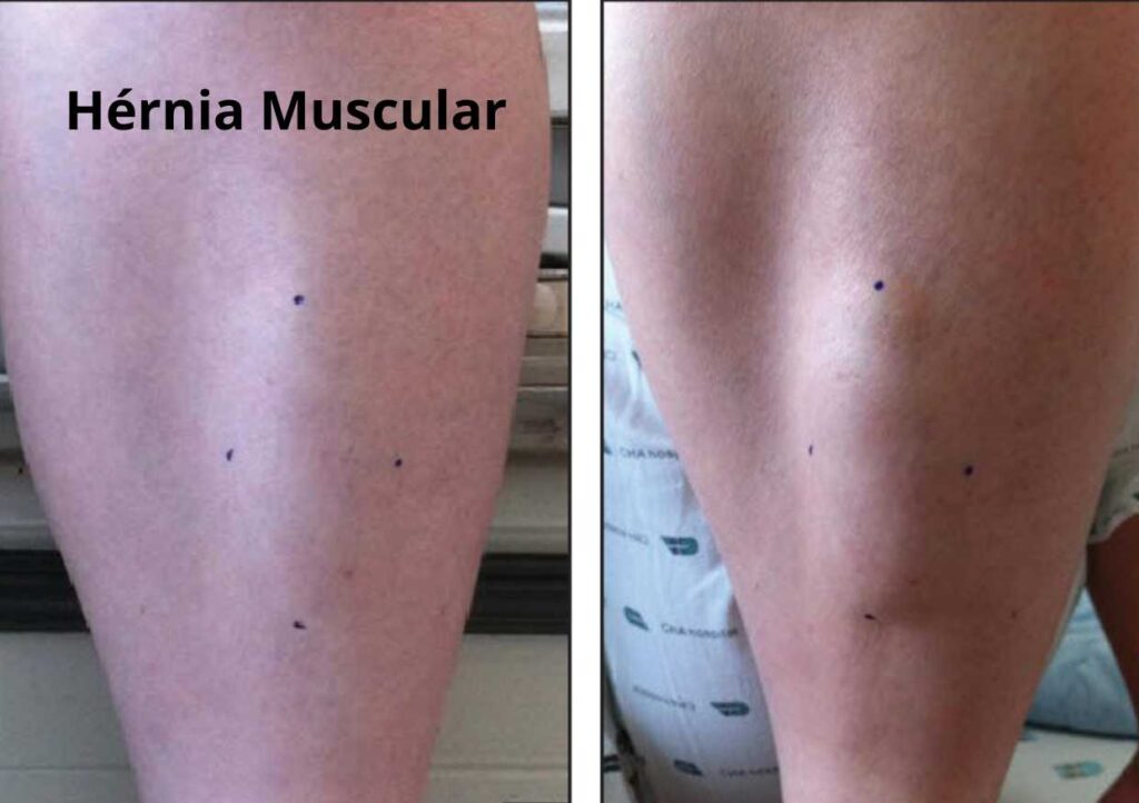 Hérnias Musculares nos Membros Inferiores | Dr. Alejandro Zoboli