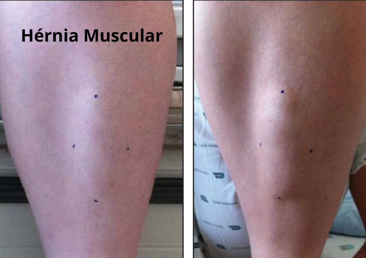 Hérnias Musculares nos Membros Inferiores | Dr. Alejandro Zoboli